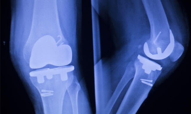 DePuy Attune Knee Replacement Failure & Risks | Unsafe Products